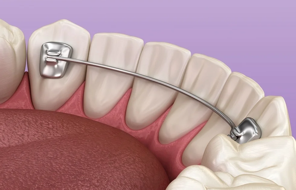 Orthodontic Retainers in NW Calgary | Orthodontic Retainers Near Me